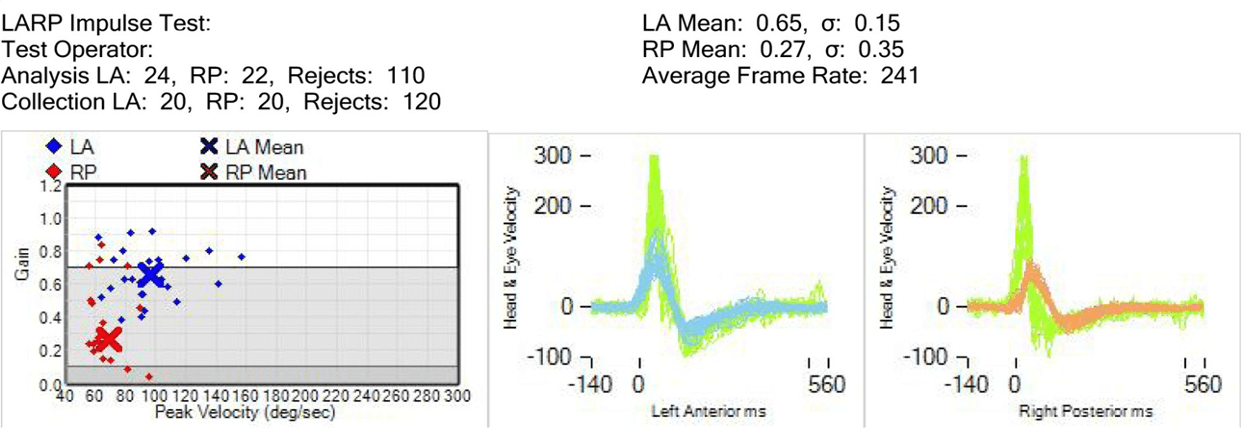 Investigatii vestibulare — Clinica Urechii Audiologie